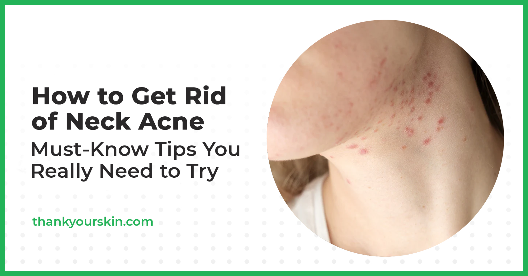 How to Get Rid of Neck Acne Fast: Must-Know Tips