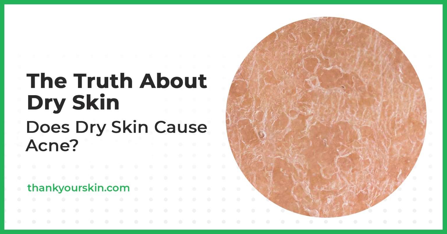 Skin Care Myth Exposed! Does Dry Skin Cause Acne?