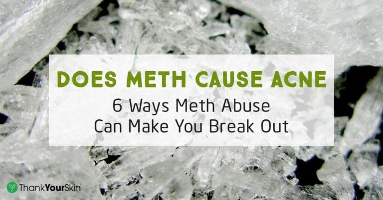 Beware Of This Acne Trigger: Does Meth Cause Acne?