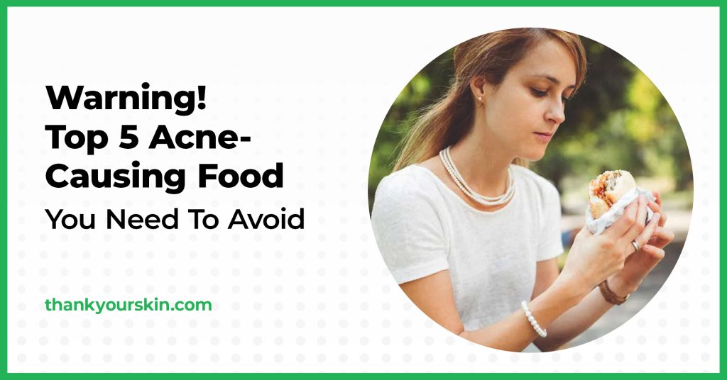 Warning! Top 5 Acne-Causing Food You Need To Avoid