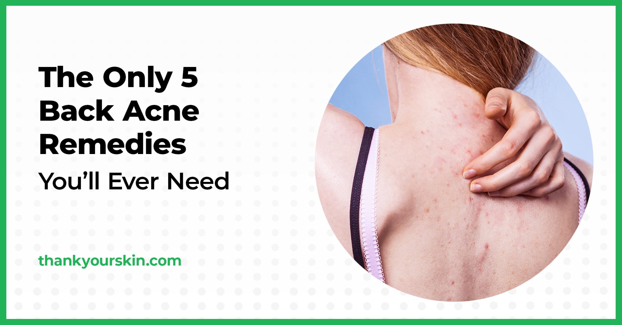 The Only 5 Back Acne Remedies You'll Ever Need