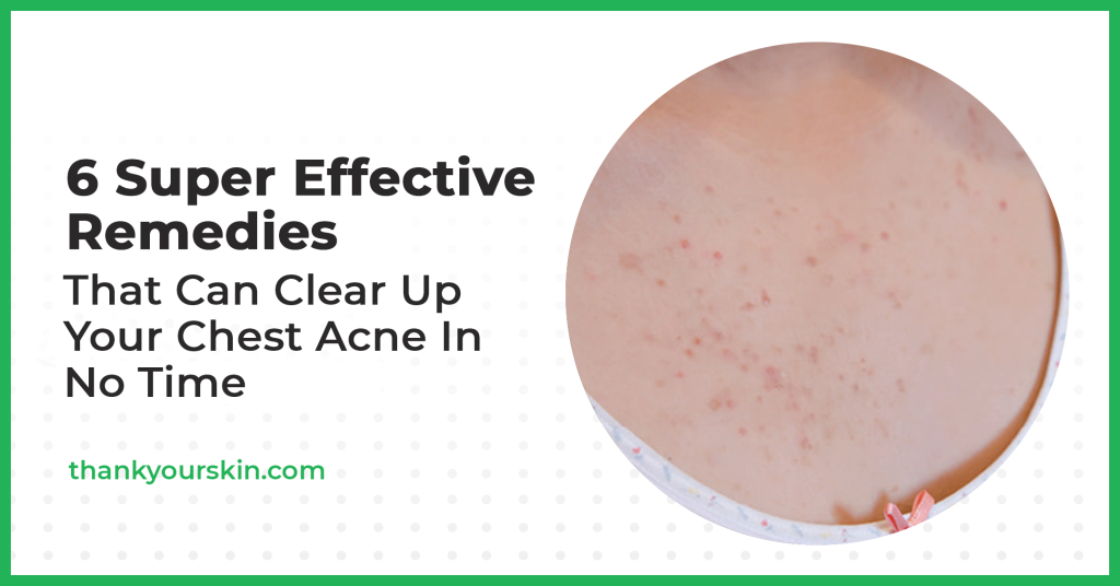 6 Super Effective Remedies That Can Clear Up Your Chest Acne In No Time