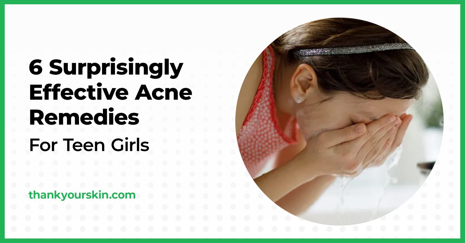 6 Surprisingly Effective Acne Remedies for Teen Girls