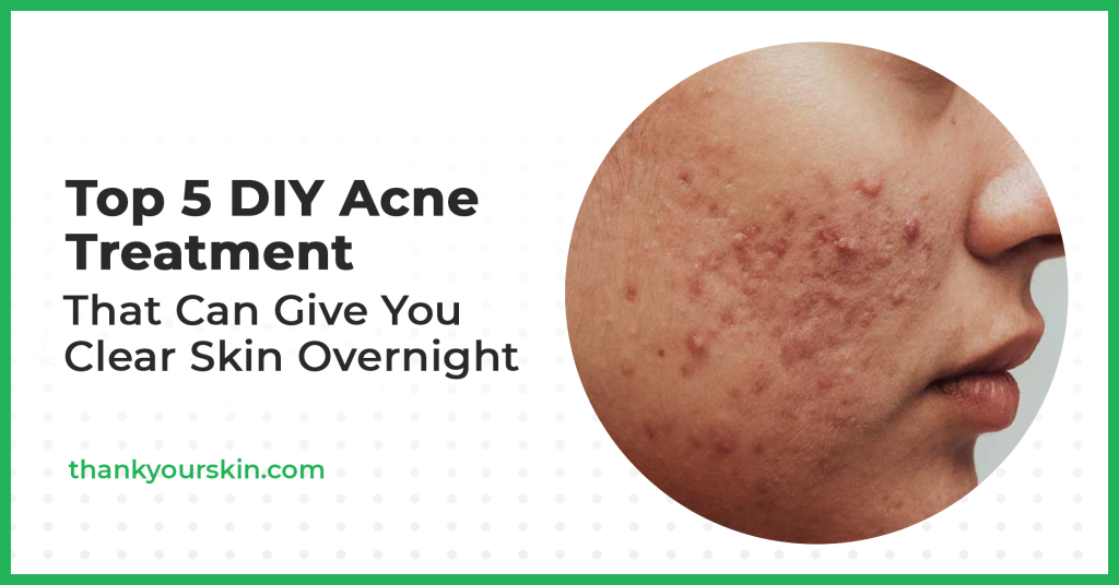 Top 5 DIY Acne Treatment That Can Give You Clear Skin Overnight