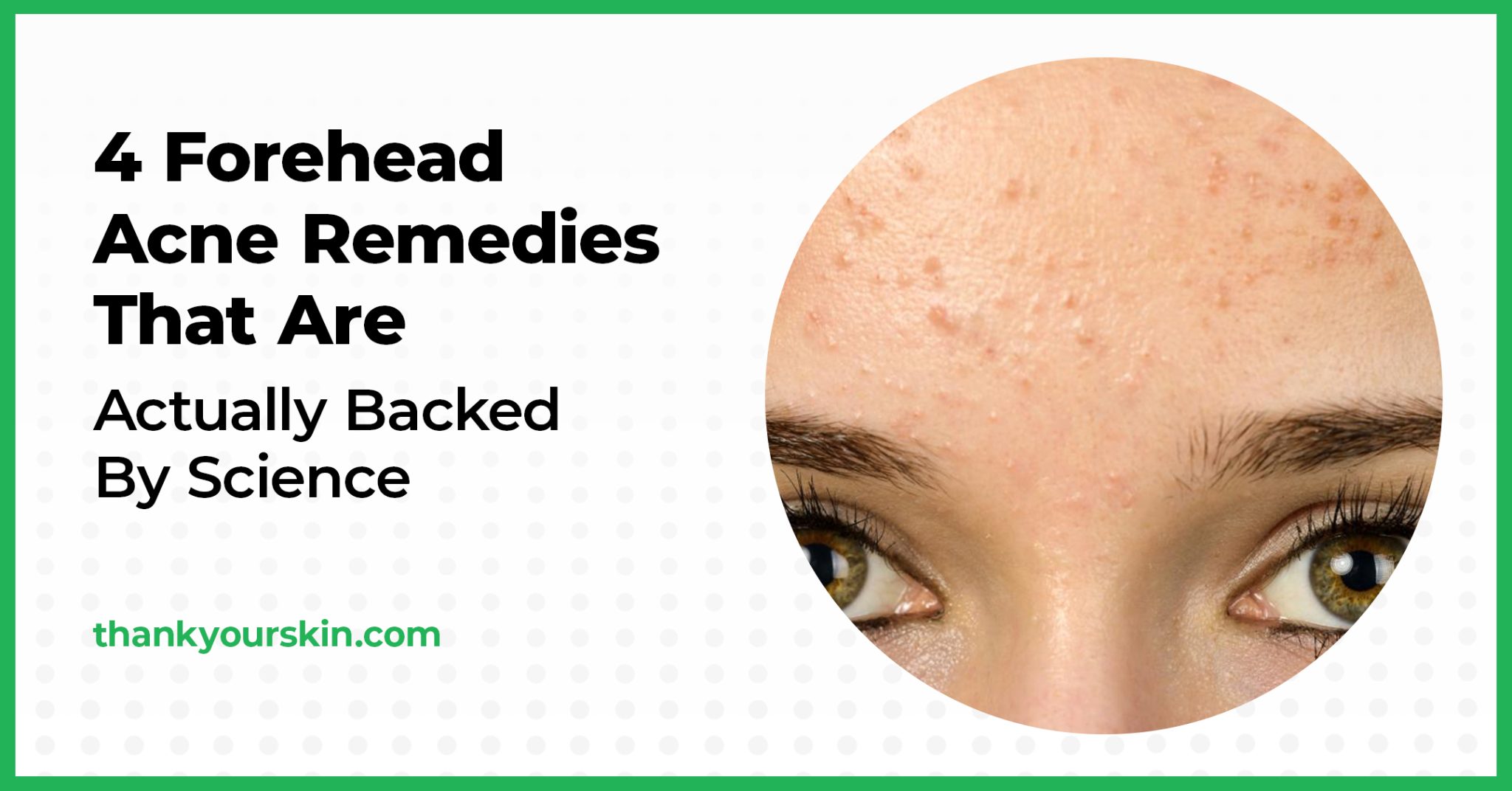 4 Forehead Acne Remedies That Are Actually Backed By Science