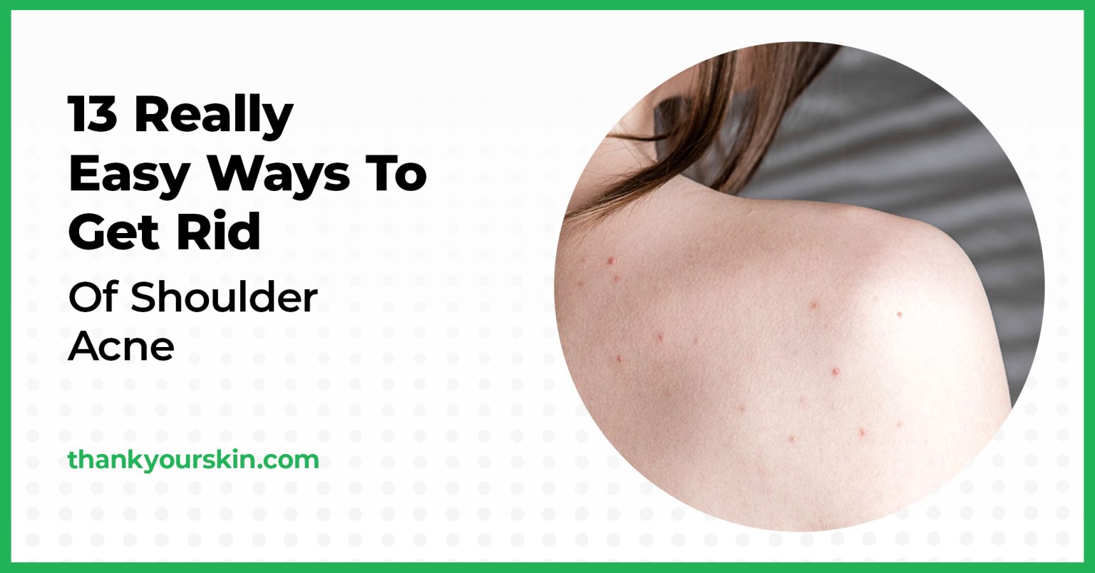 13 Really Easy Ways To Get Rid of Shoulder Acne