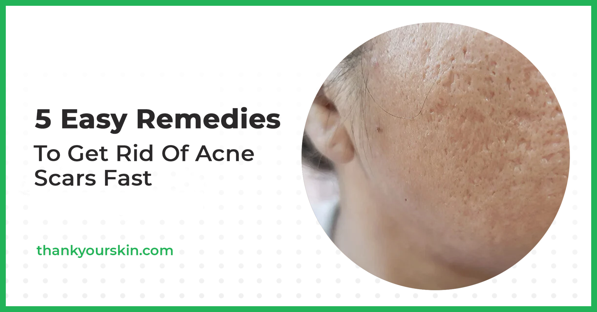 5 Easy Remedies To Get Rid Of Acne Scars Fast