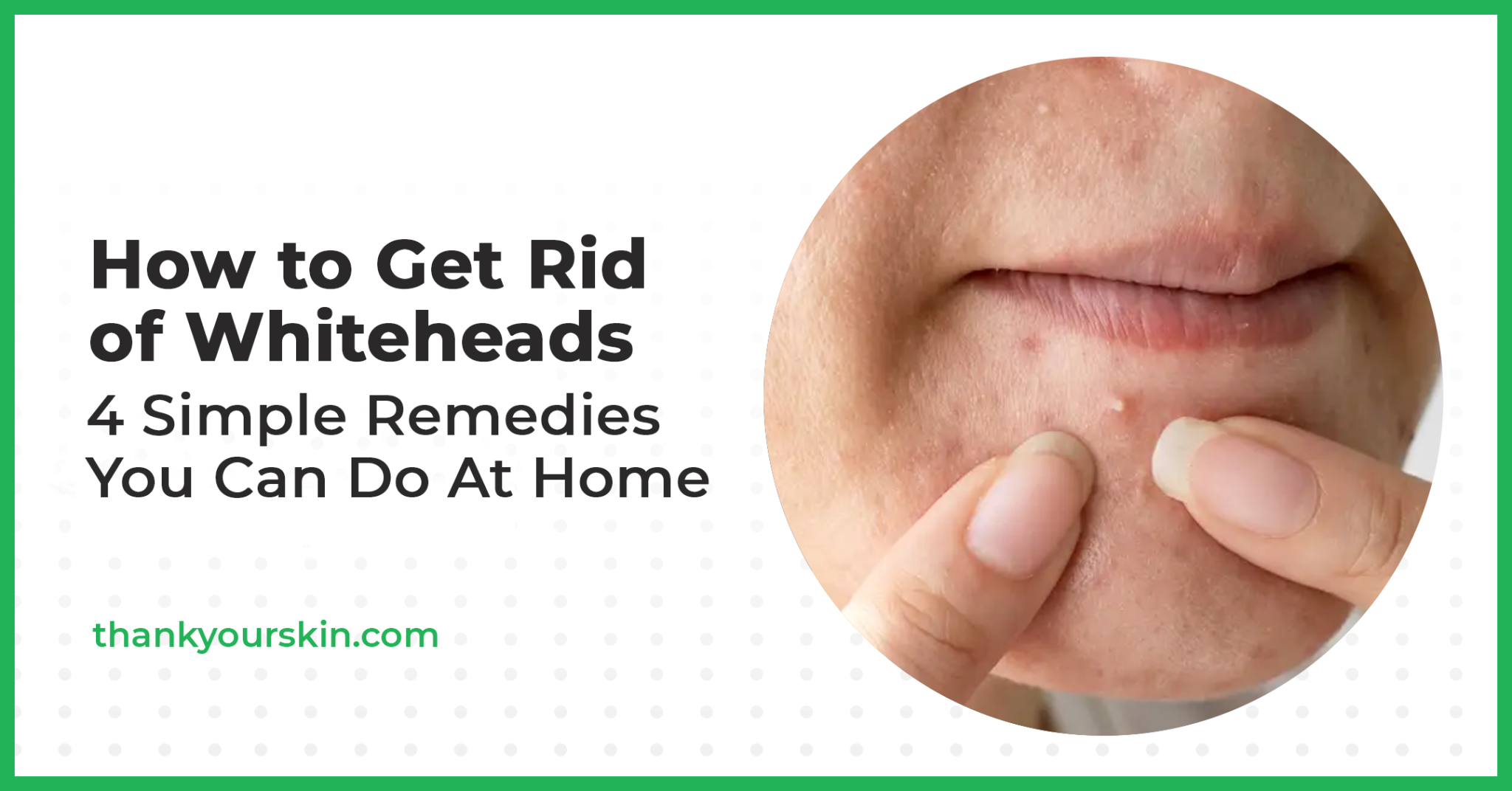 How to Get Rid of Whiteheads: 4 Simple Remedies You Can Do At Home
