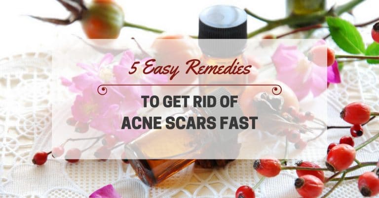 5 Easy Remedies To Get Rid Of Acne Scars Fast