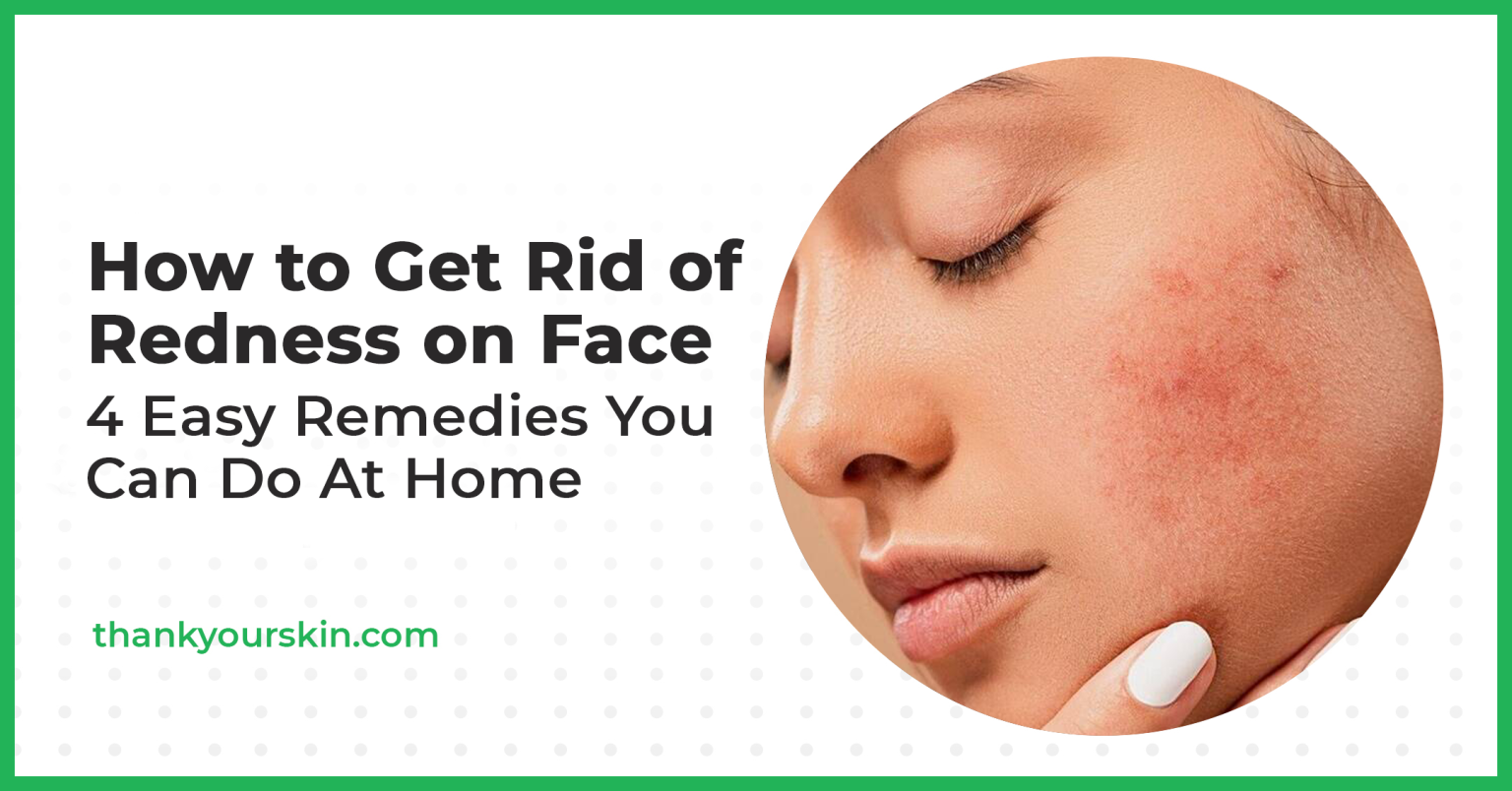 How to Get Rid of Redness on Face: 4 Easy Remedies You Can Do At Home