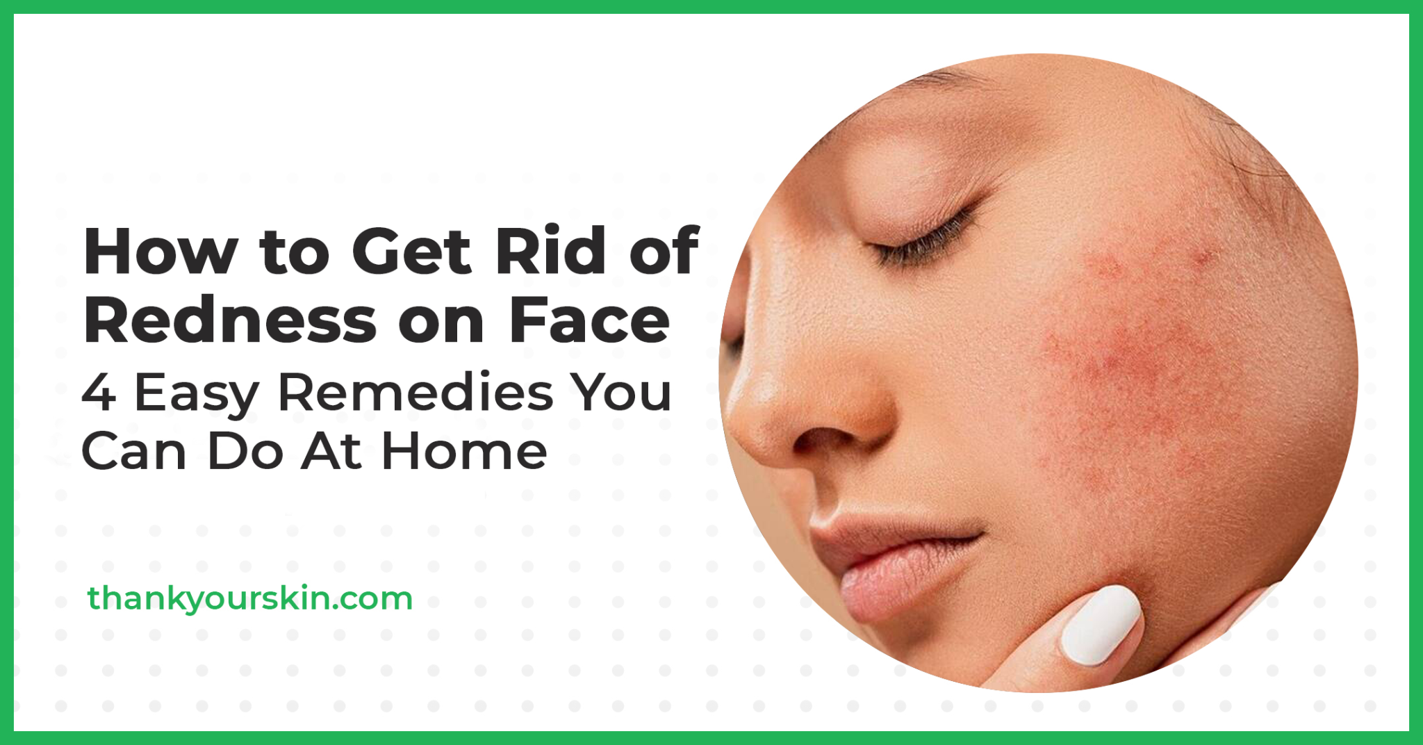 How To Get Rid Of Redness On Face 4 Easy Remedies You Can Do At Home
